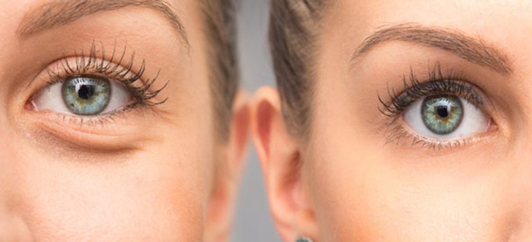 Puffy Eyes - Why, When, And How To Reduce Them