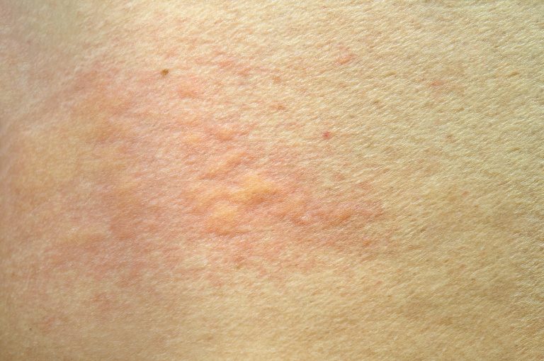 Can Allergy Shots Cure my Chronic Hives? What You Need To Know!