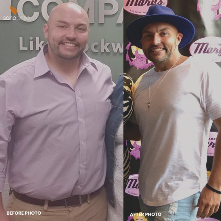 Trisculpt Micro-Laser Liposuction - 10 Things You Need To Know!