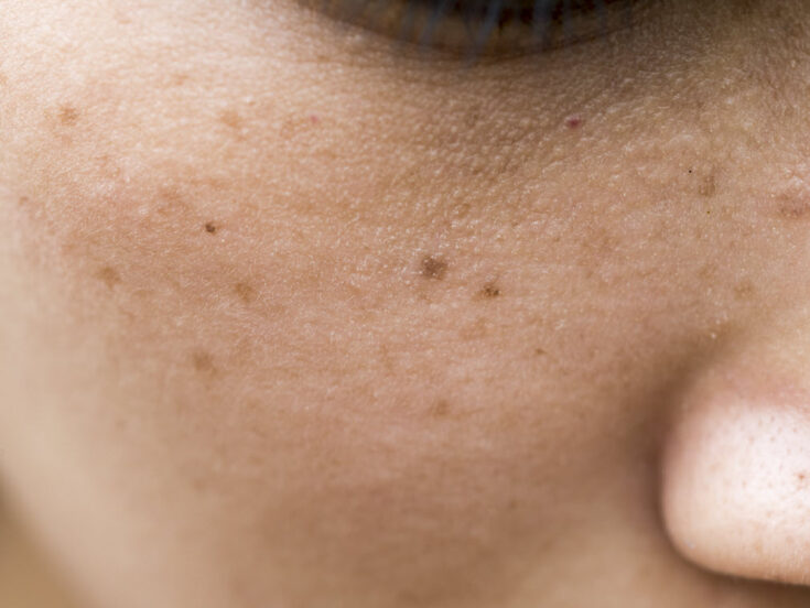 What is Hyperpigmentation And What Can I Do About It?